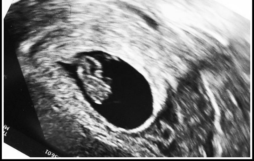 8th Week of Pregnancy – Fetal Growth