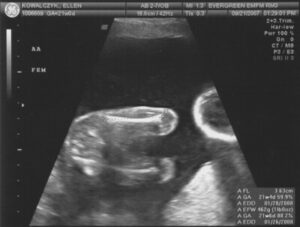 Short Femur Length in Pregnancy: When to Worry and What to Do – Fetal ...