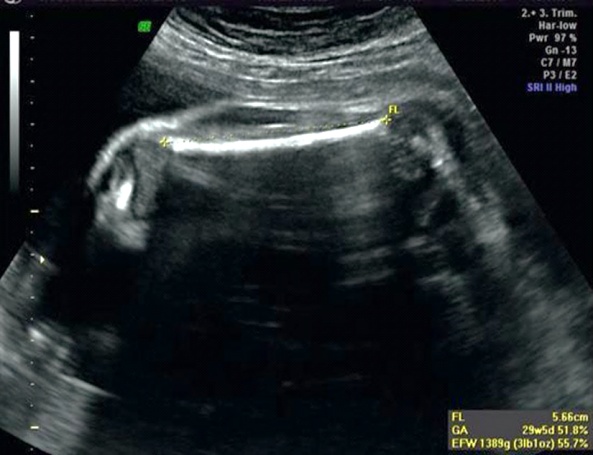 When to worry about short femur length pregnancy – Fetal Growth